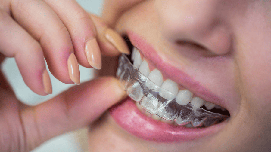 What are the differences between Retainers and Clear aligners?